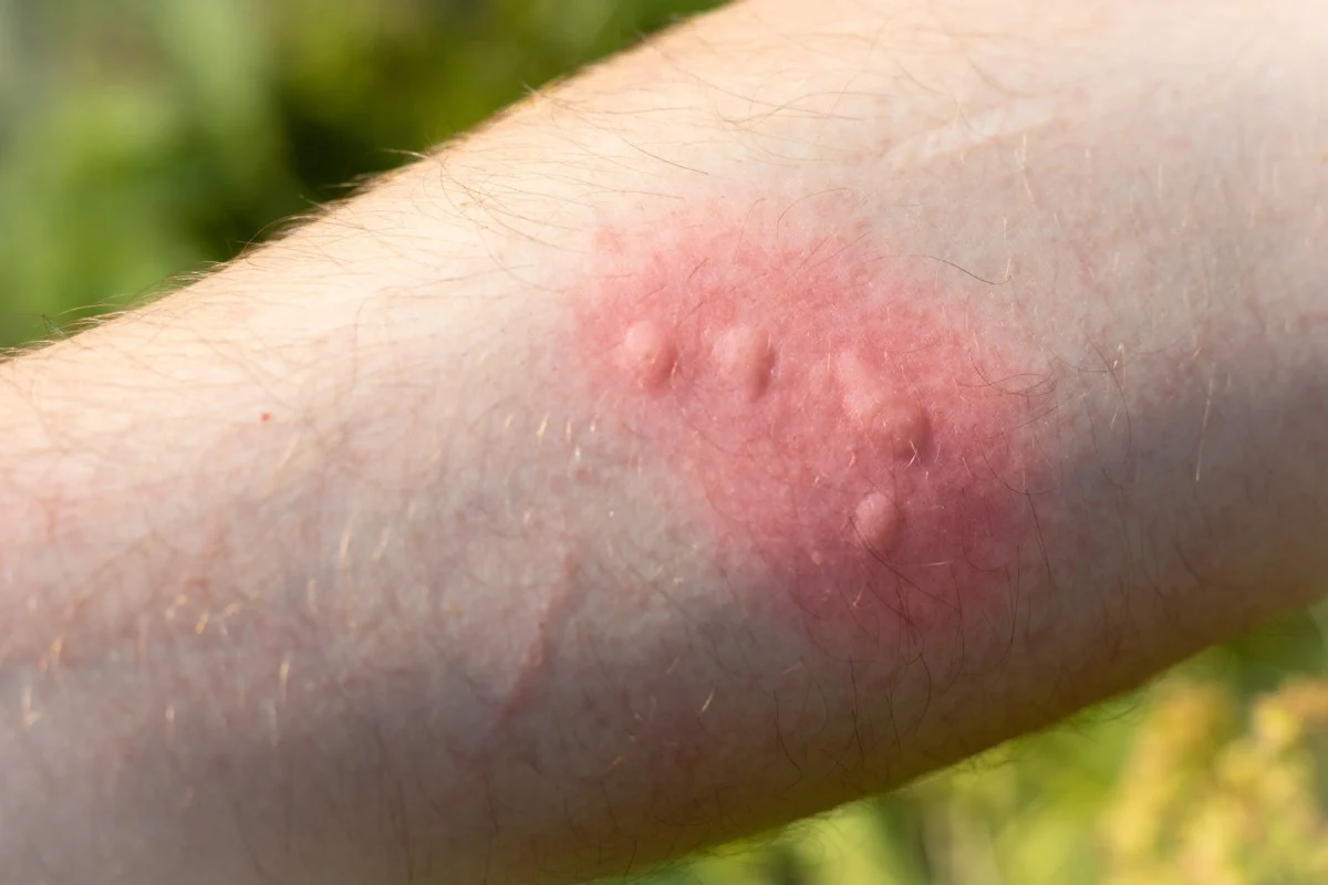 Nettle Plant Rash